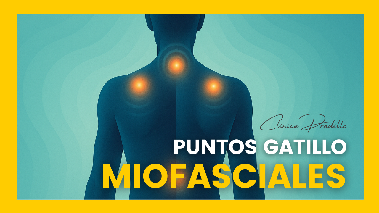 Puntos gatillo miofasciales